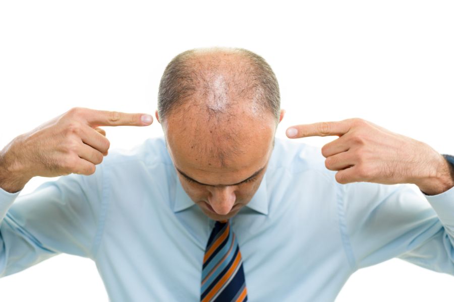Hereditary Hair Loss Cause Symptoms And Solutions Traya