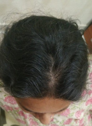 Hair Loss Treatment for Women - Holistic Hair fall Solutions for ...